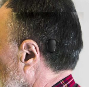 Abutment Passive Bone Conduction Hearing Implant – YAIS