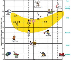 Criteria for Cochlear Implants – YAIS